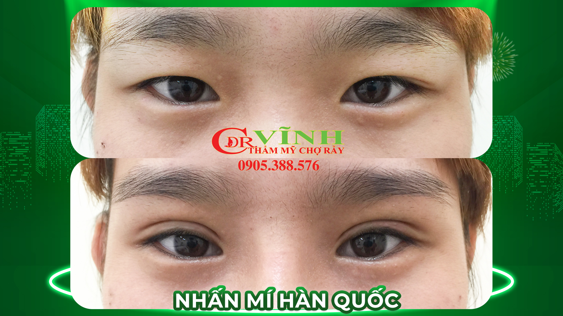 Nhấn mí Hàn Quốc là gì và 5 bước quan trọng cần phải biết