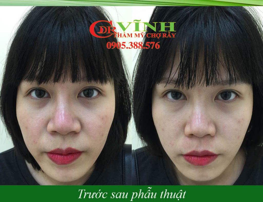 Phẫu thuật cắt cánh mũi: quy trình, kết quả và lưu ý sau phẫu thuật