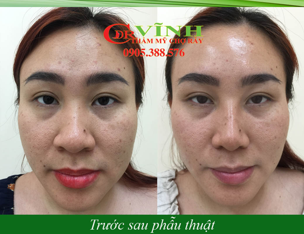 Phẫu thuật cắt cánh mũi: quy trình, kết quả và lưu ý sau phẫu thuật