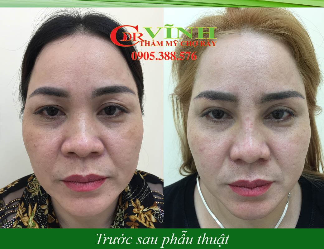 Phẫu thuật cắt cánh mũi: quy trình, kết quả và lưu ý sau phẫu thuật