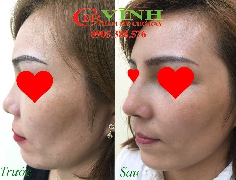 Nâng mũi bệnh viện Chợ Rẫy - Bác sĩ Lê Hoàng Vĩnh | Bác sĩ Chợ Rẫy