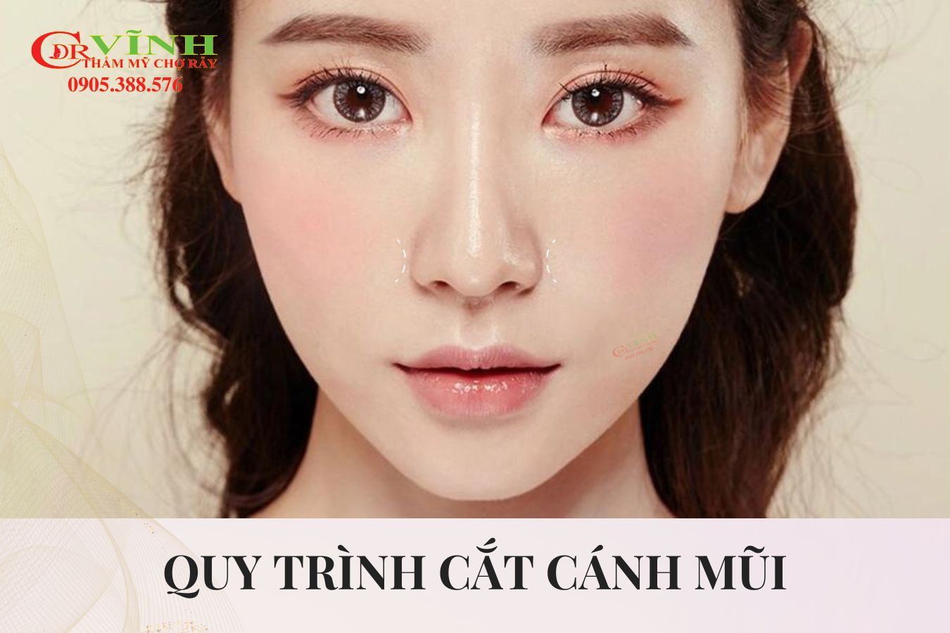Phẫu thuật cắt cánh mũi: quy trình, kết quả và lưu ý sau phẫu thuật